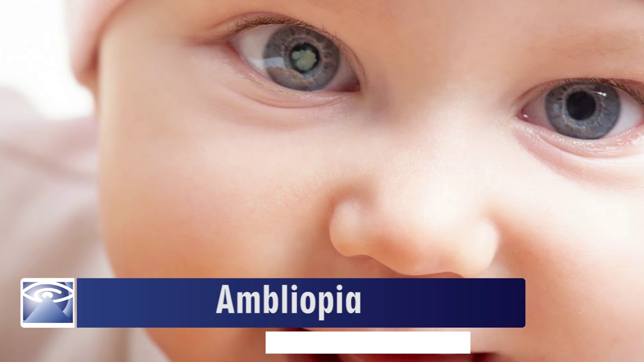 ¿Que es Ambliopia? - YouTube
