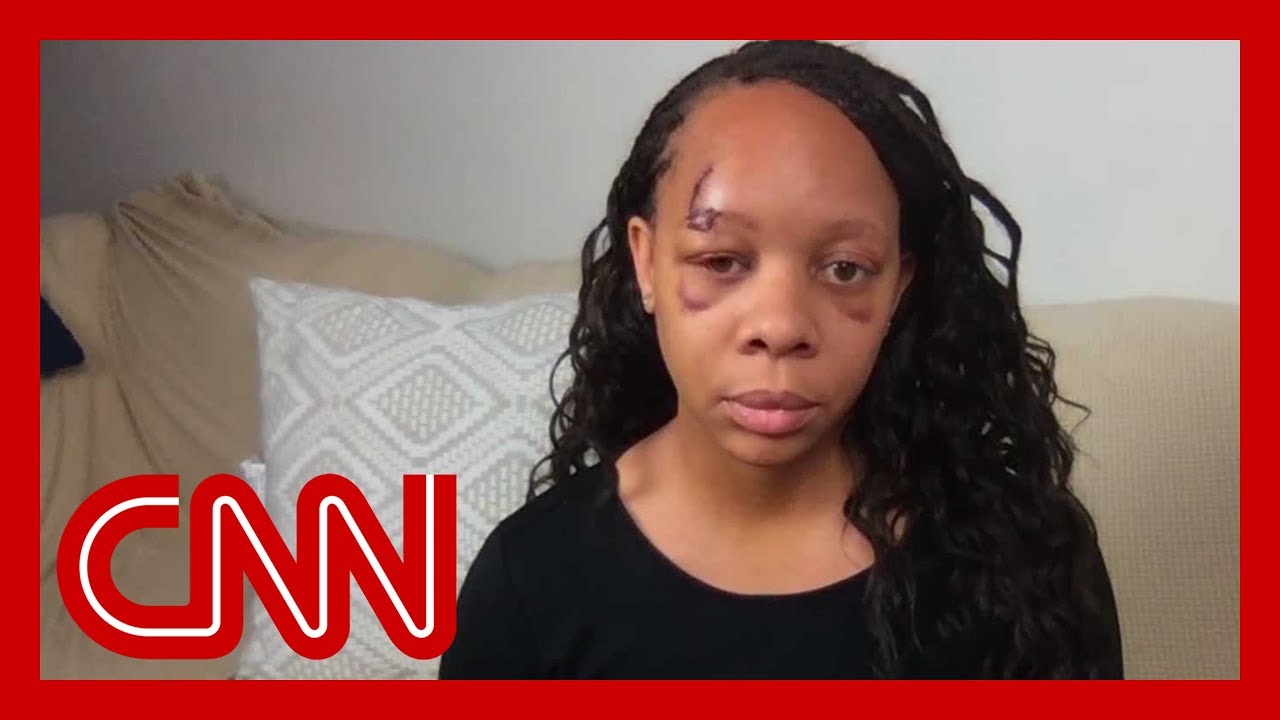 Woman shot in face by police with rubber bullet: I want to know why ...