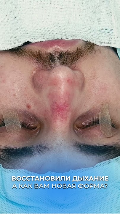 РИНОПЛАСТИКА В МАХАЧКАЛЕ - МАХОЧИ ШАМИЛОВИЧ. Бесплатная консультация по воцап +7 928 555 9966 ...