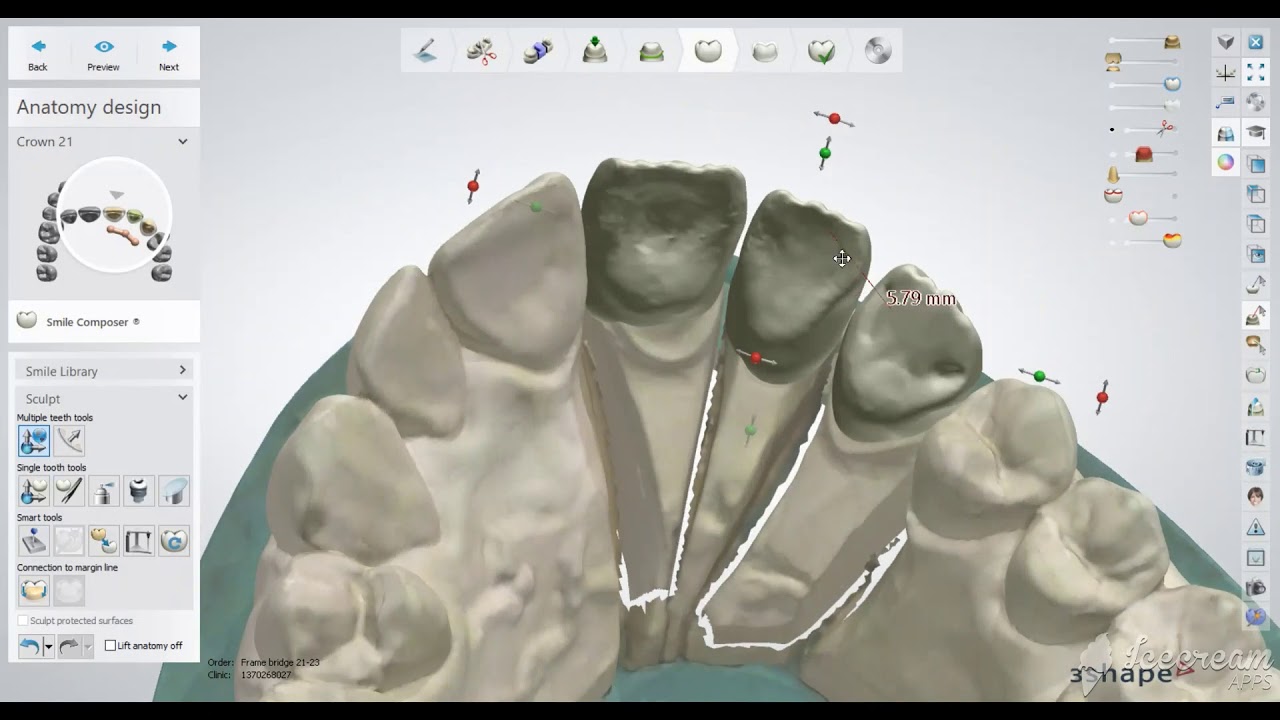 3 unit bridge cutback with pontic 3shape - YouTube