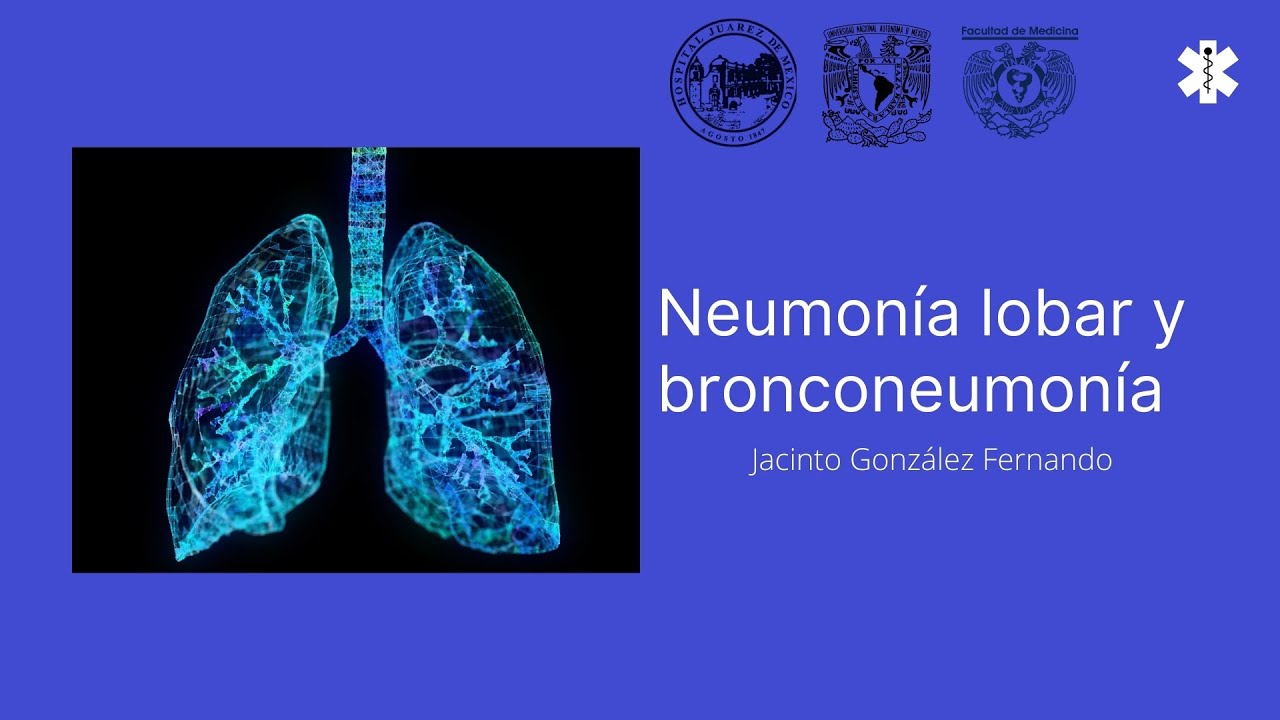 Neumonía lobular, Bronconeumonía y Daño Alveolar Difuso - YouTube
