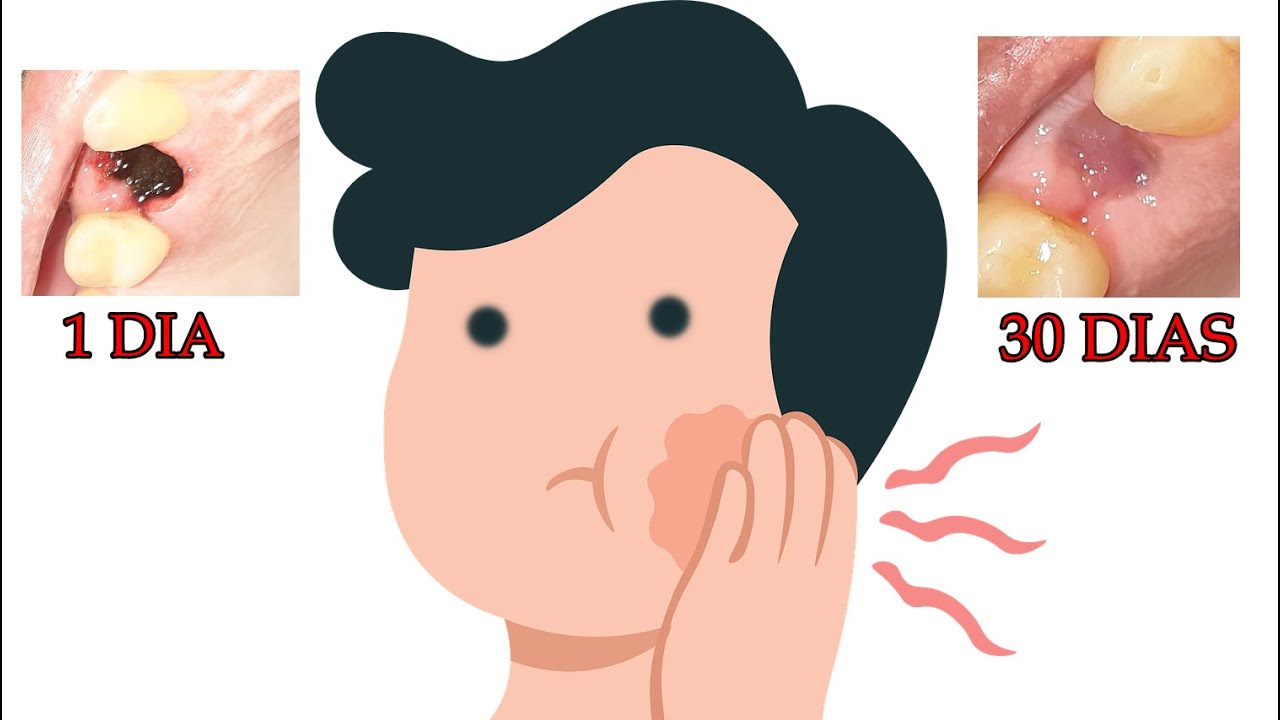 Proceso de Curación de una extracción de muela dia a dia. - YouTube
