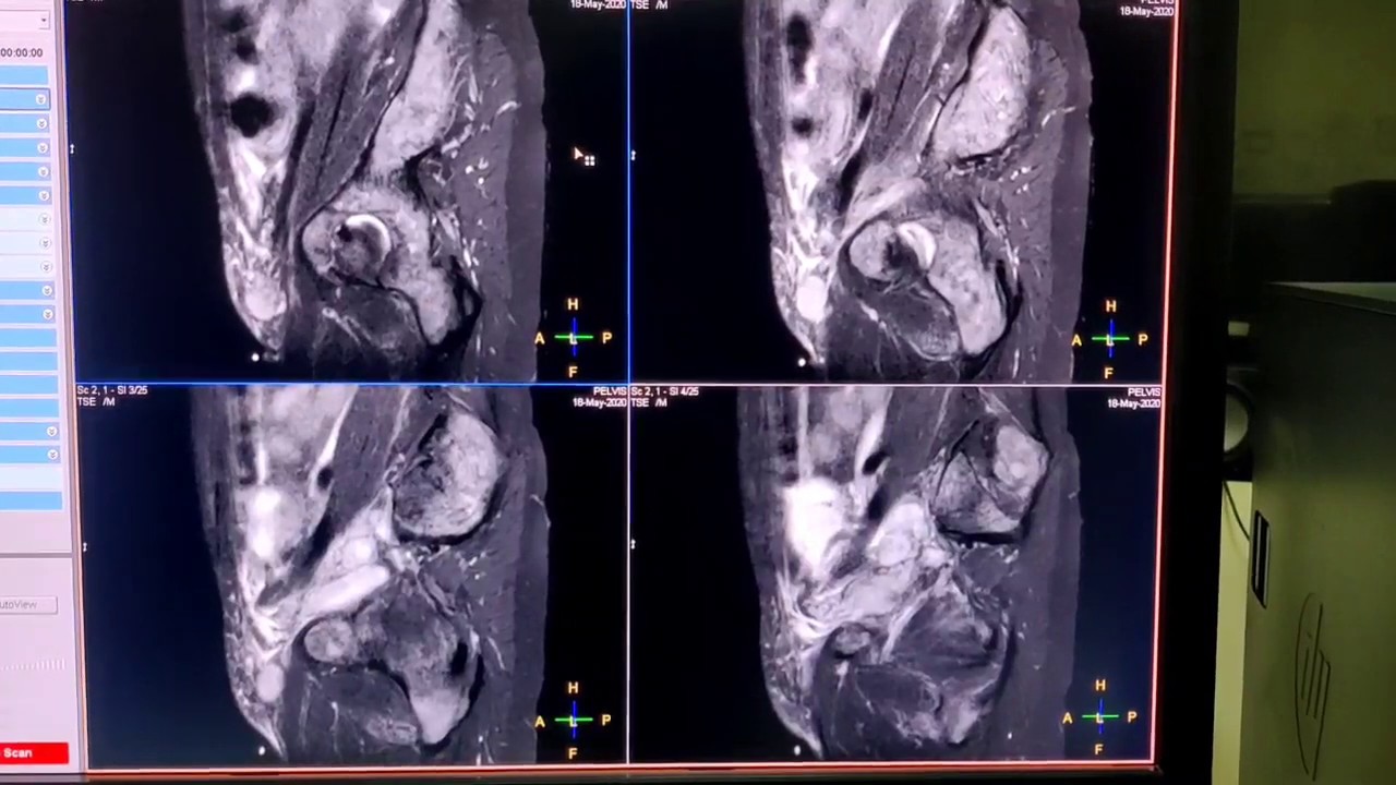 MRI Female MITOTIC URINARY BLADDER MASSES WITH PELVIC ADENOPATHY - YouTube
