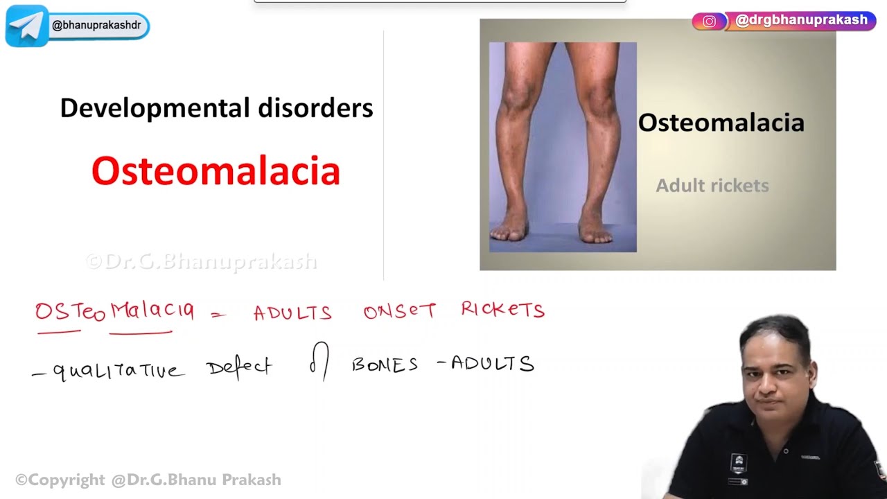 Osteomalacia : Orthopedic Lectures 🦴🌞🥛 - YouTube