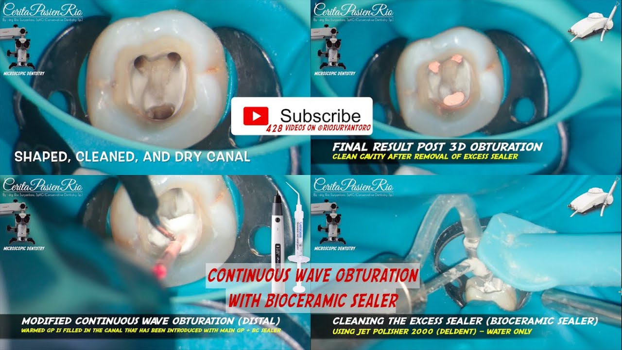 modified continuous wave obturation technique ceraseal fast fill fast ...