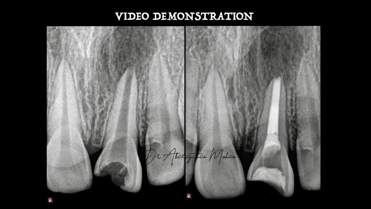 NEW SIMPLIFIED APEXIFICATION TECHNIQUE DEMONSTRATION - YouTube