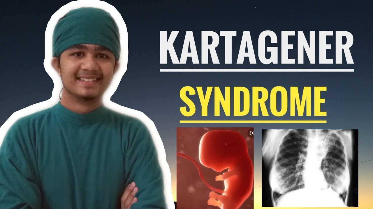 What Is Kartagener Syndrome | Kartagener Syndrome Explanations | Medico ...