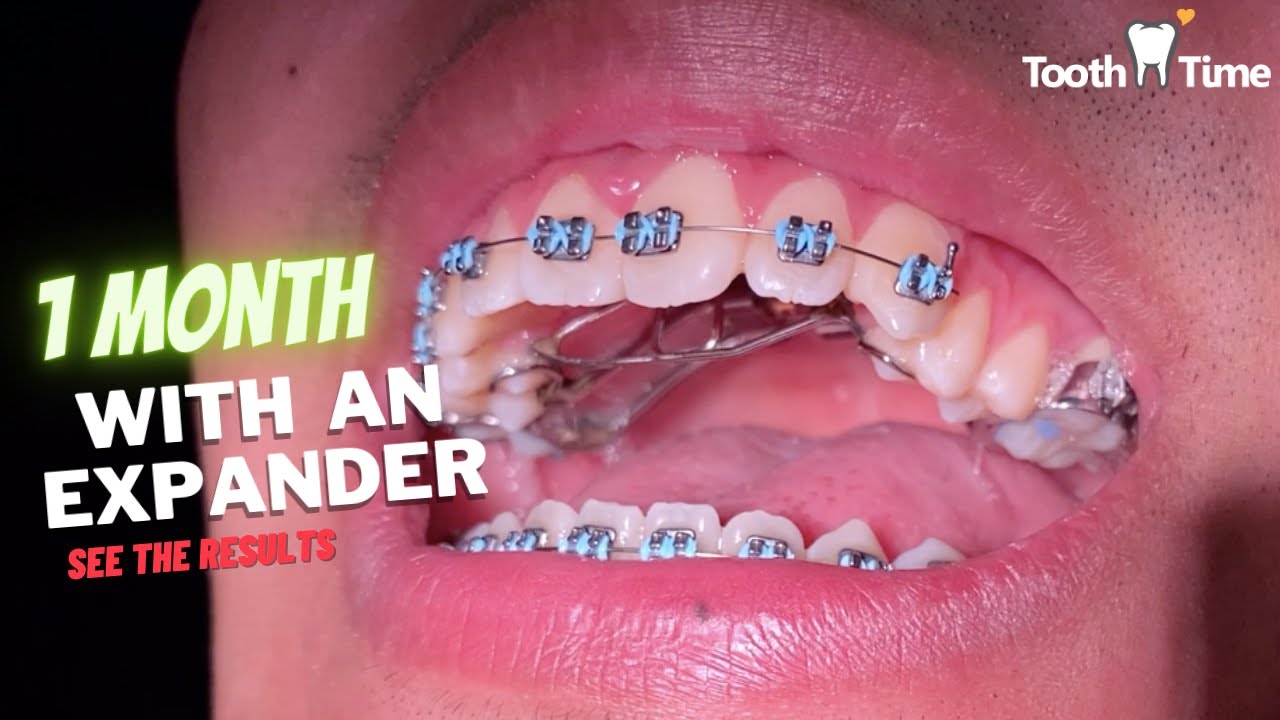 A month with an expander - Amazing results - Tooth Time Family ...