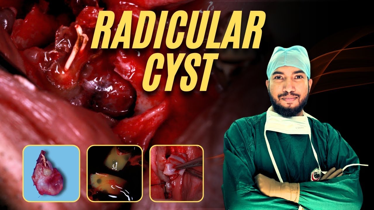 Radicular Cyst Enucleation - YouTube