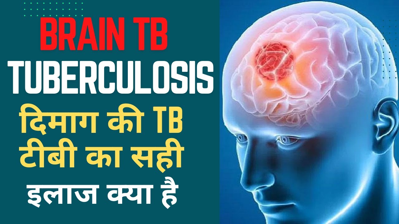 Brain Tb Tuberculosis दिमाग की TB टीबी का सही इलाज क्या है Dr. Naveen Kumar Ailawadi - YouTube