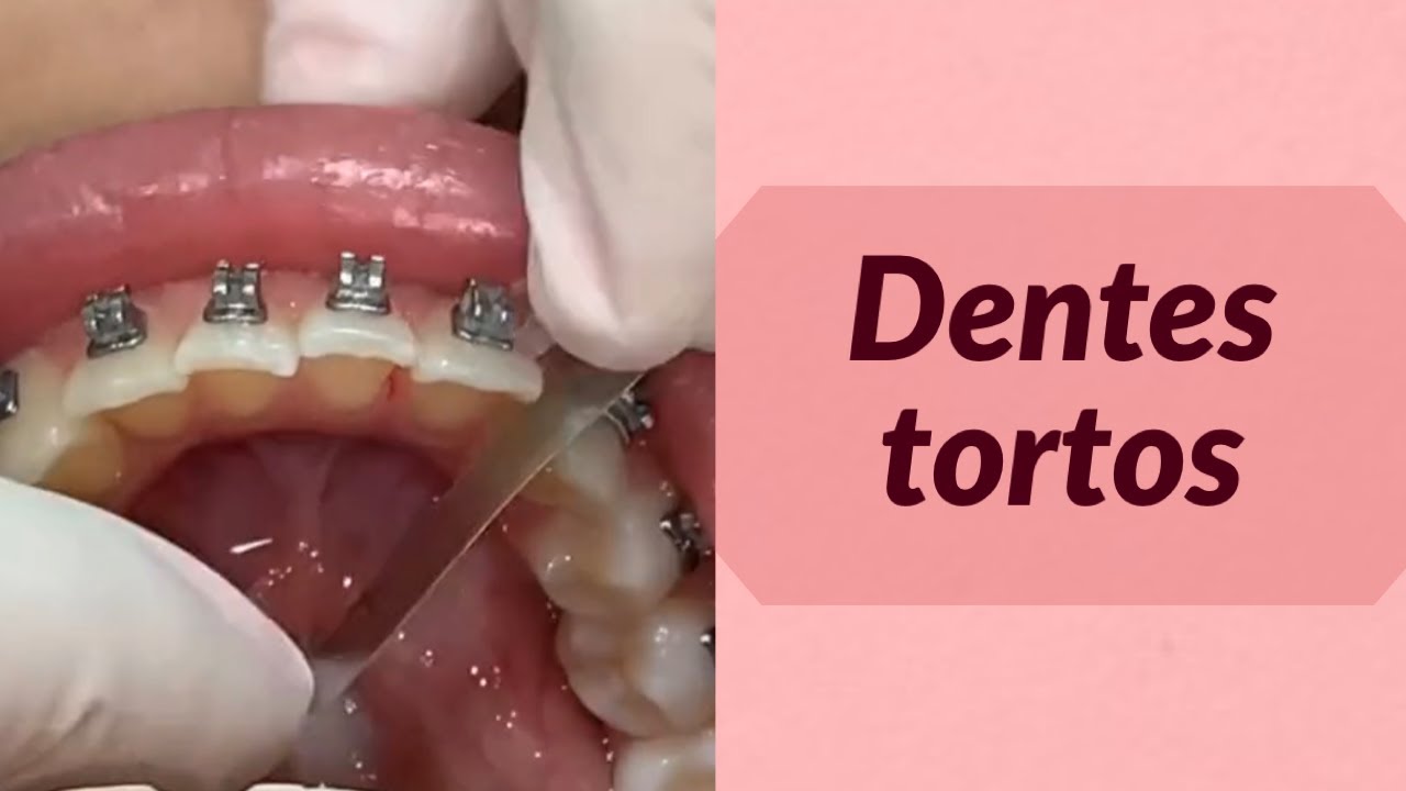 DENTES TORTOS - YouTube