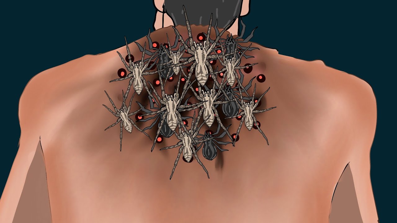 ASMR Treatment Removal Infact Spider Form Man Back | Asmr 2d Deep ...