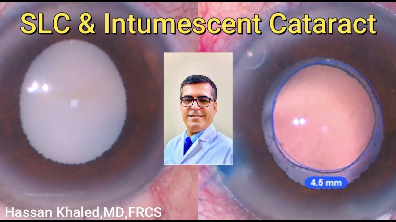 SLC & intumescent Cataract - YouTube