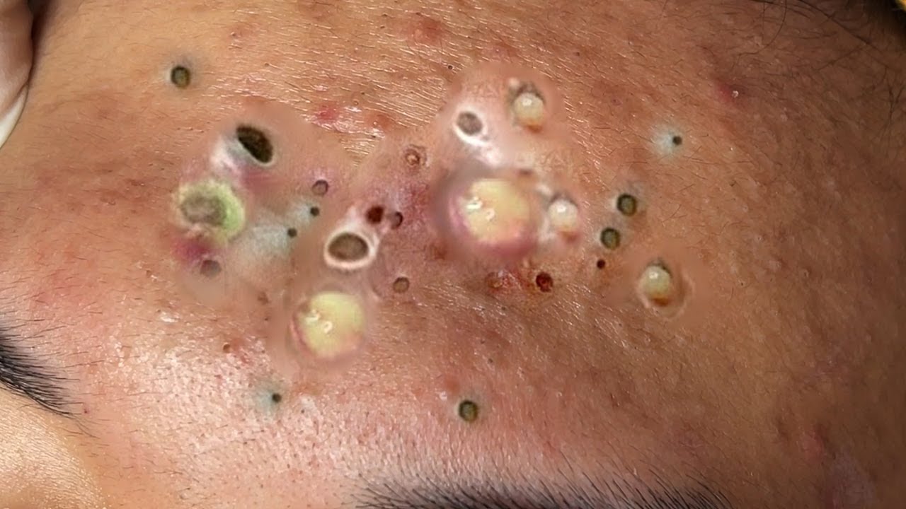 Close-Up Blackhead Removal from Deep Facial Pores #113 - YouTube