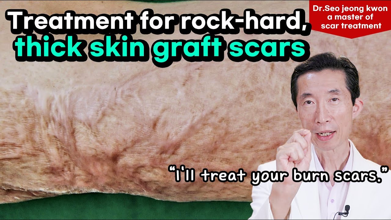 I've treated these rock-hard skin graft scars to become as smooth as if ...
