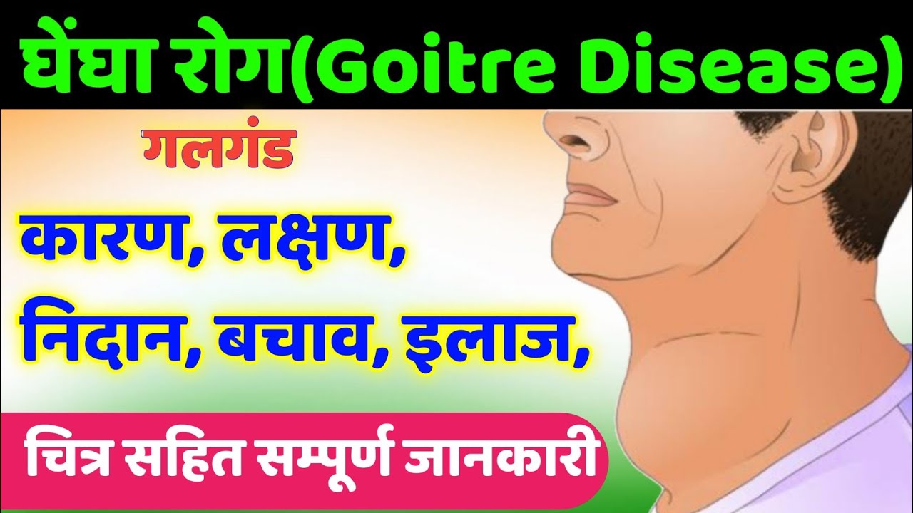 घेंघा रोग (Goitre Disease) | घेंघा के लक्षण, कारण, बचाव, इलाज | ghengha ...