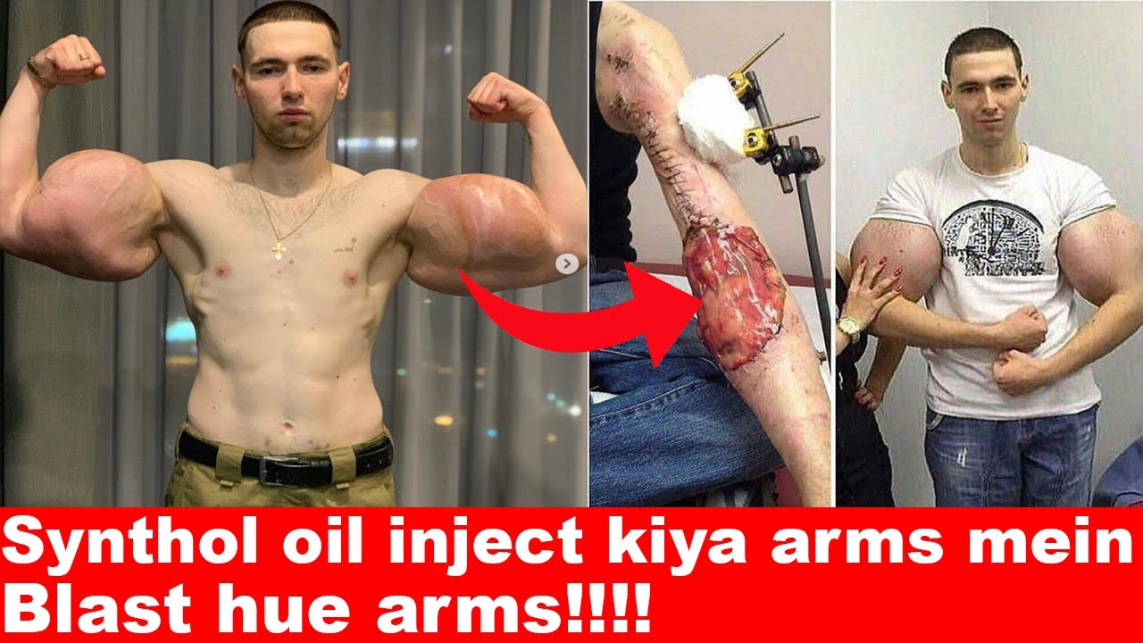 Synthol Injury