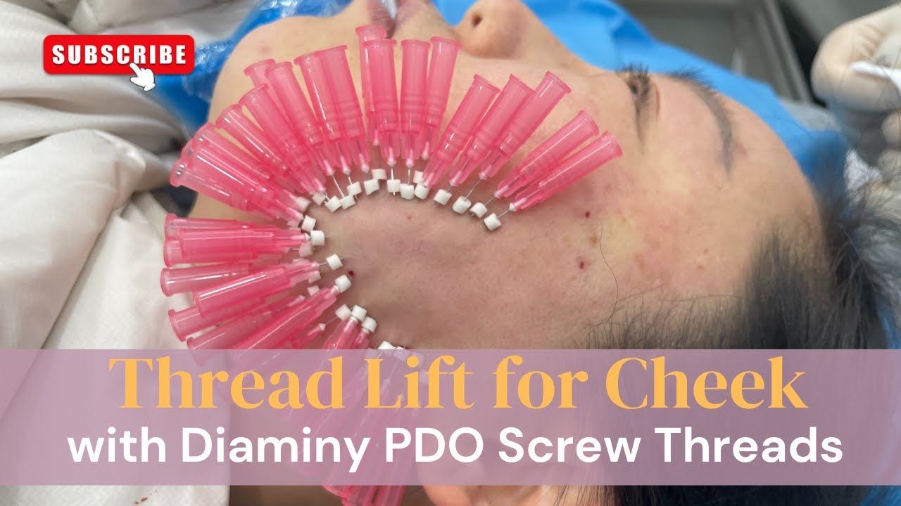 Diaminy PDO screw thread lift for cheek - YouTube