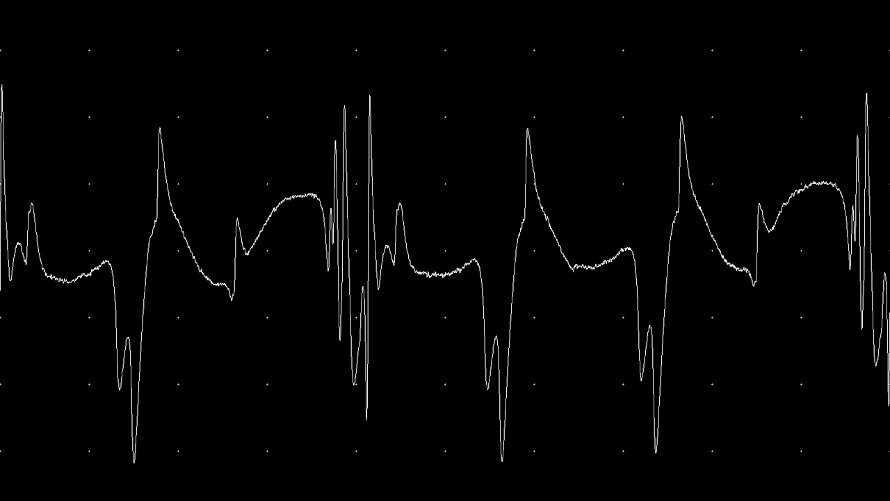 Complex repetitive discharge - YouTube