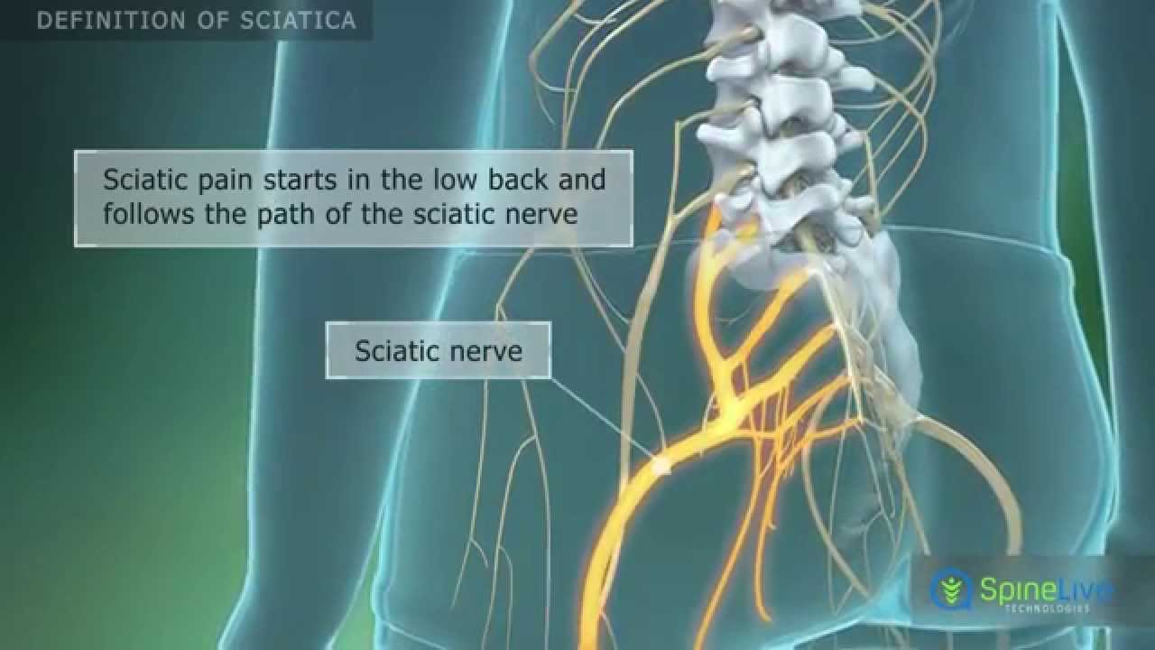 Sciatica Definition - YouTube
