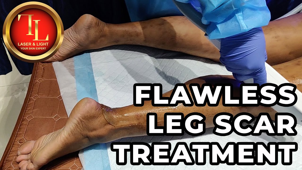 Leg Scar Removal Treatment - YouTube