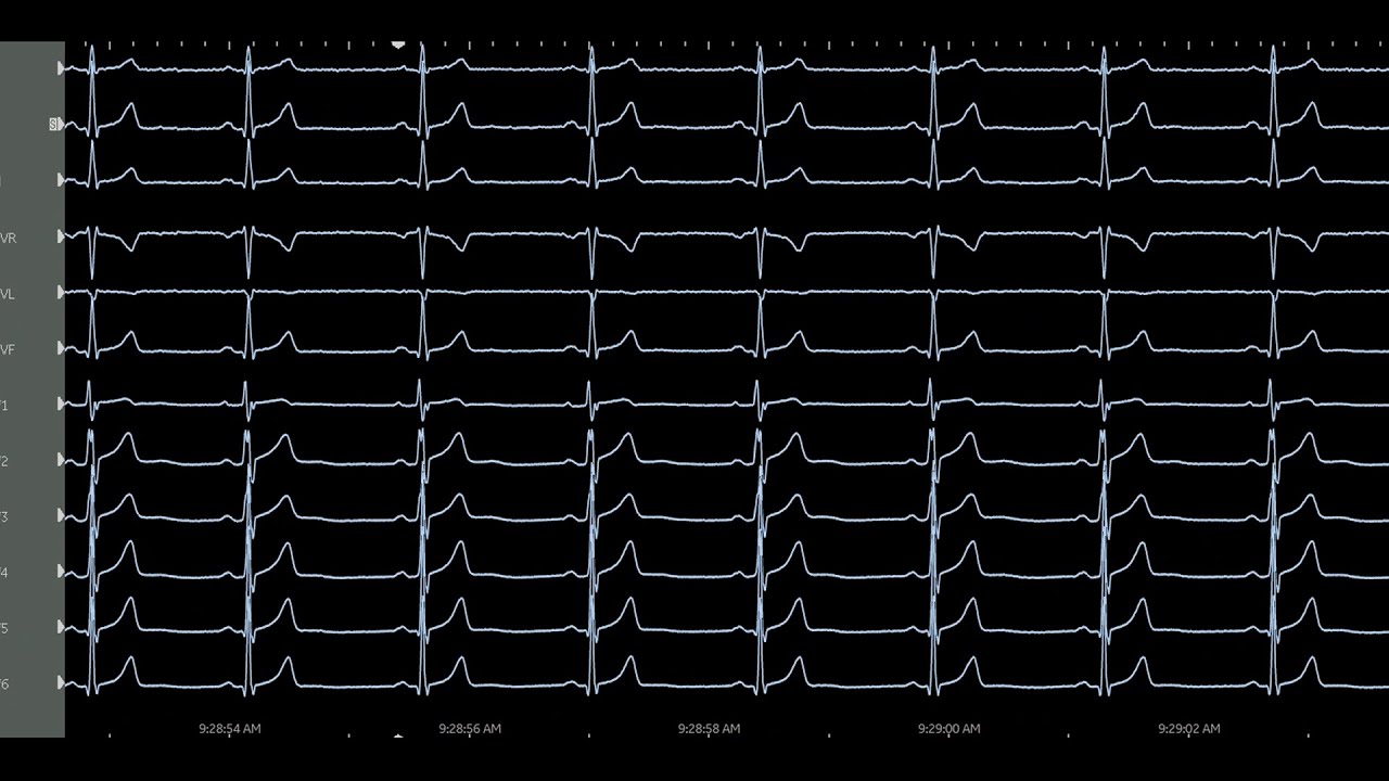 Continuous 12-Lead Electrocardiogram During Vertebral Vein Stimulation ...