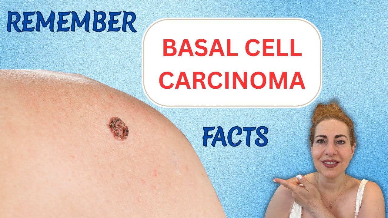 The Most Common Skin Cancer: Basal Cell Carcinoma Explained in Under 5 ...