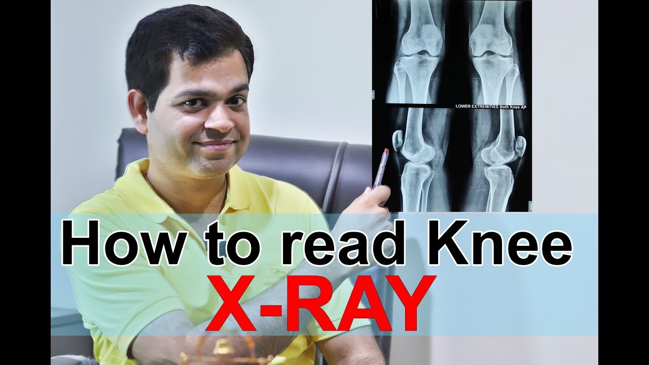 Learn To Read X ray Online Meaning Of X Ray HINDI Knee X Ray learn-to-read-x-ray-online-meaning-of-x-ray-hindi-knee-x-ray