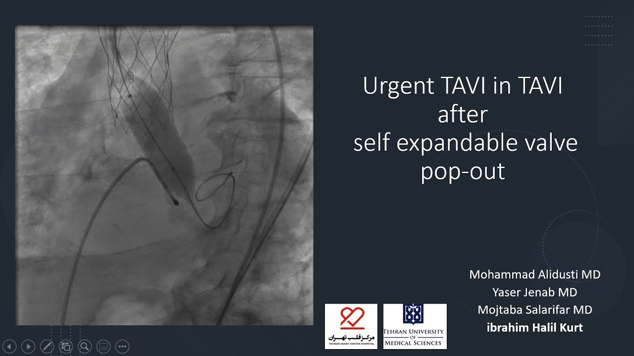 Urgent TAVI in TAVI after self expandable valve pop out - YouTube