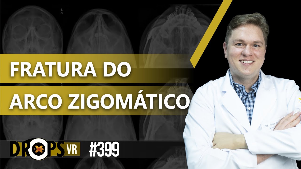 FRATURA DO ARCO ZIGOMÁTICO NA RADIOGRAFIA E TC - YouTube