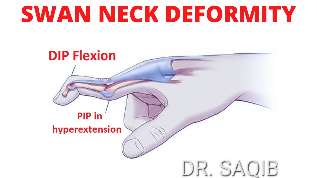 Swan Neck Deformity | Tendon Lesions and Finger Deformities ...