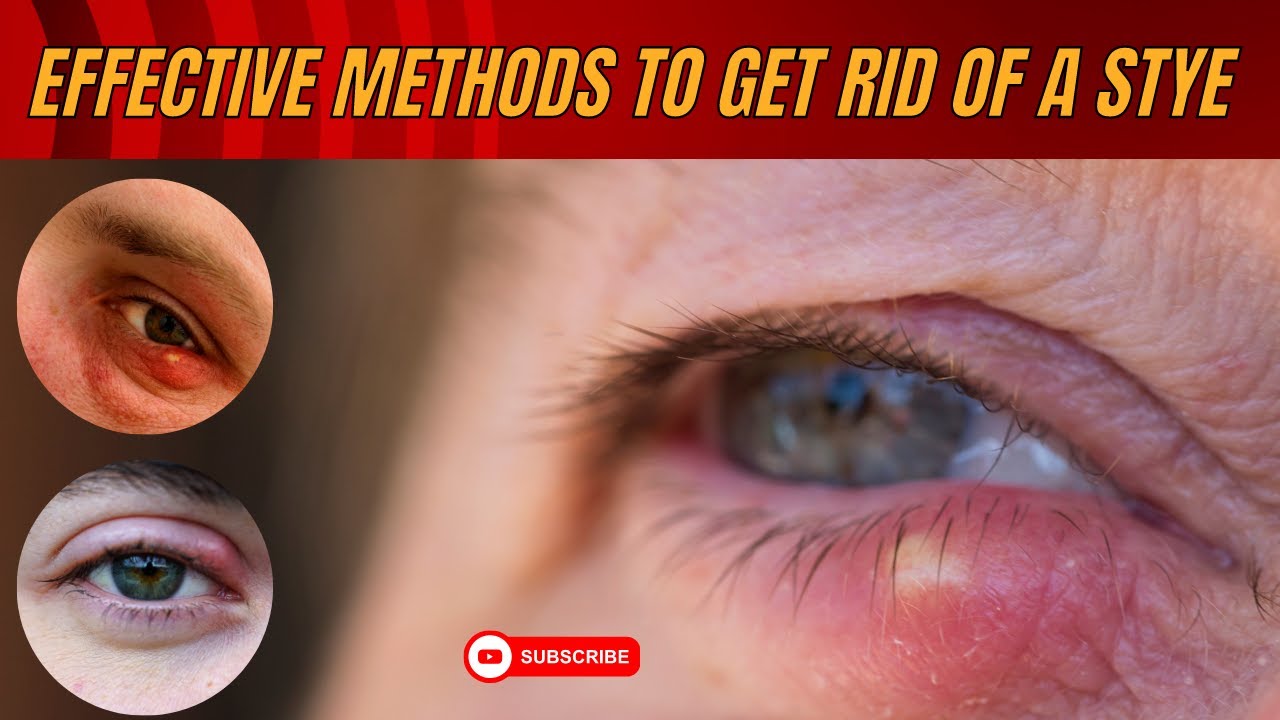 How to get rid of stye FAST | Eye Stye Home Remedy - YouTube