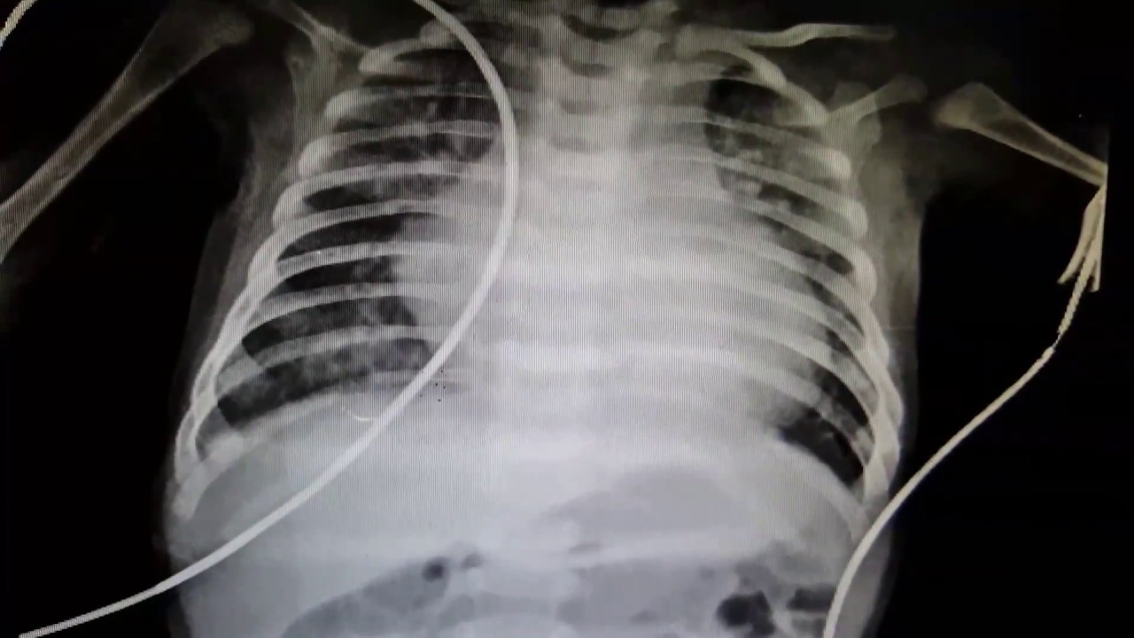 total anomalous pulmonary venous connection, TAPVC, cxr looks like RDS ...