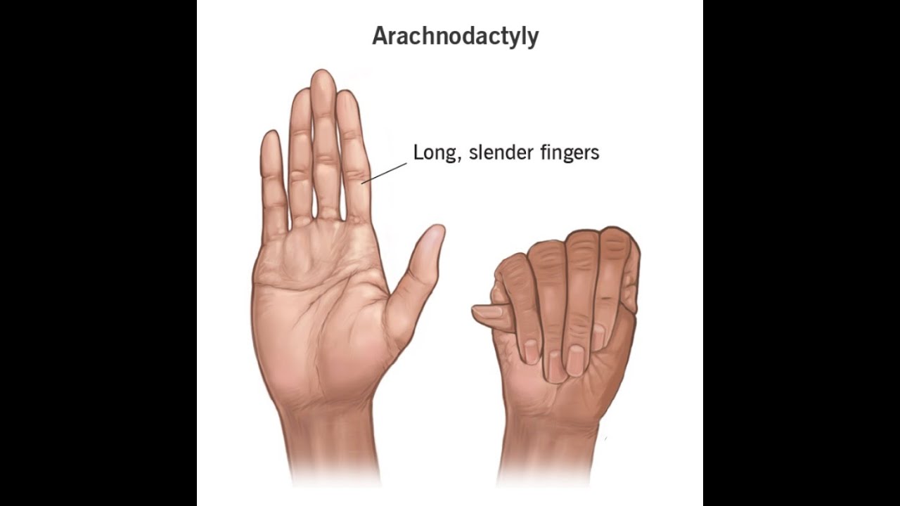 Arachnodactyly Or spider Like fingers ; Defintion, Causes, Symptoms ...