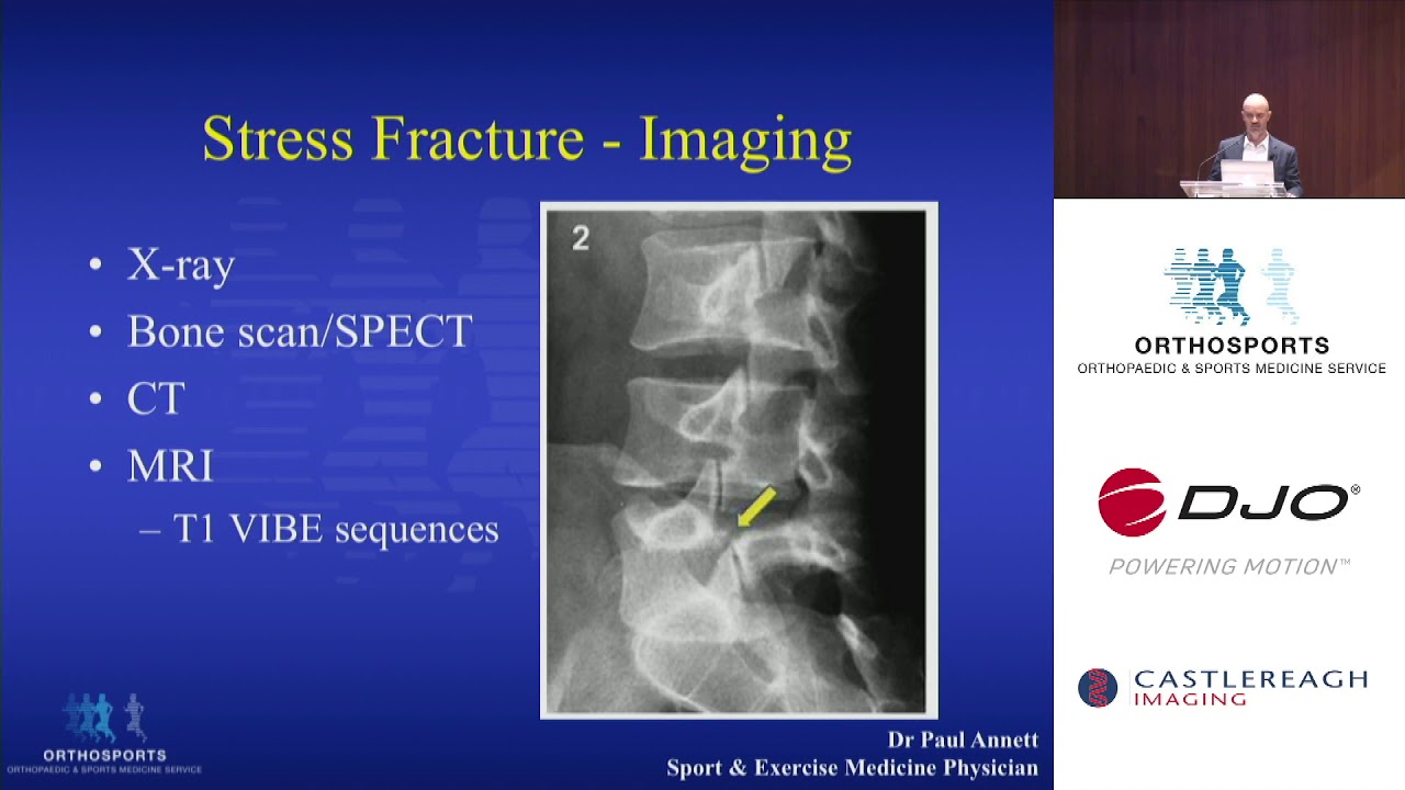 2019 06 Lumbar stress fractures Dr Paul Annett - YouTube