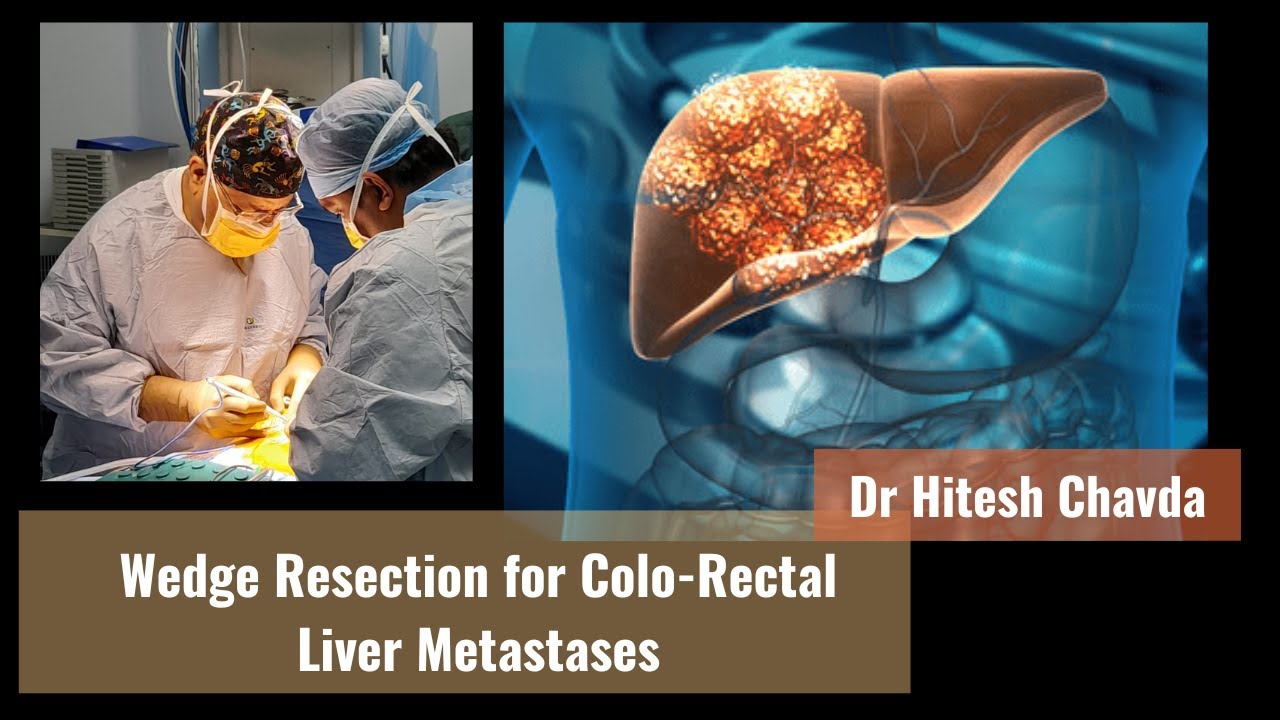 Wedge Liver Resection for Colo-Rectal Liver Metastases Using Kelly ...