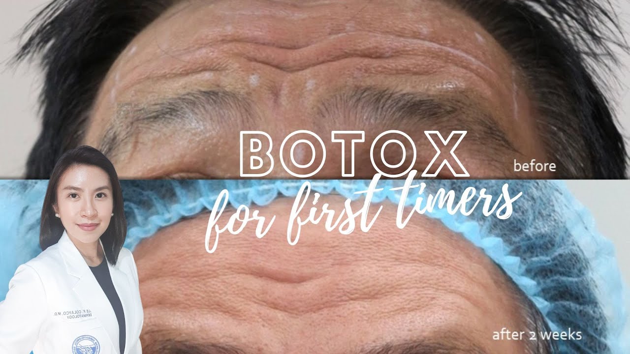Botox Tips for First Timers - YouTube