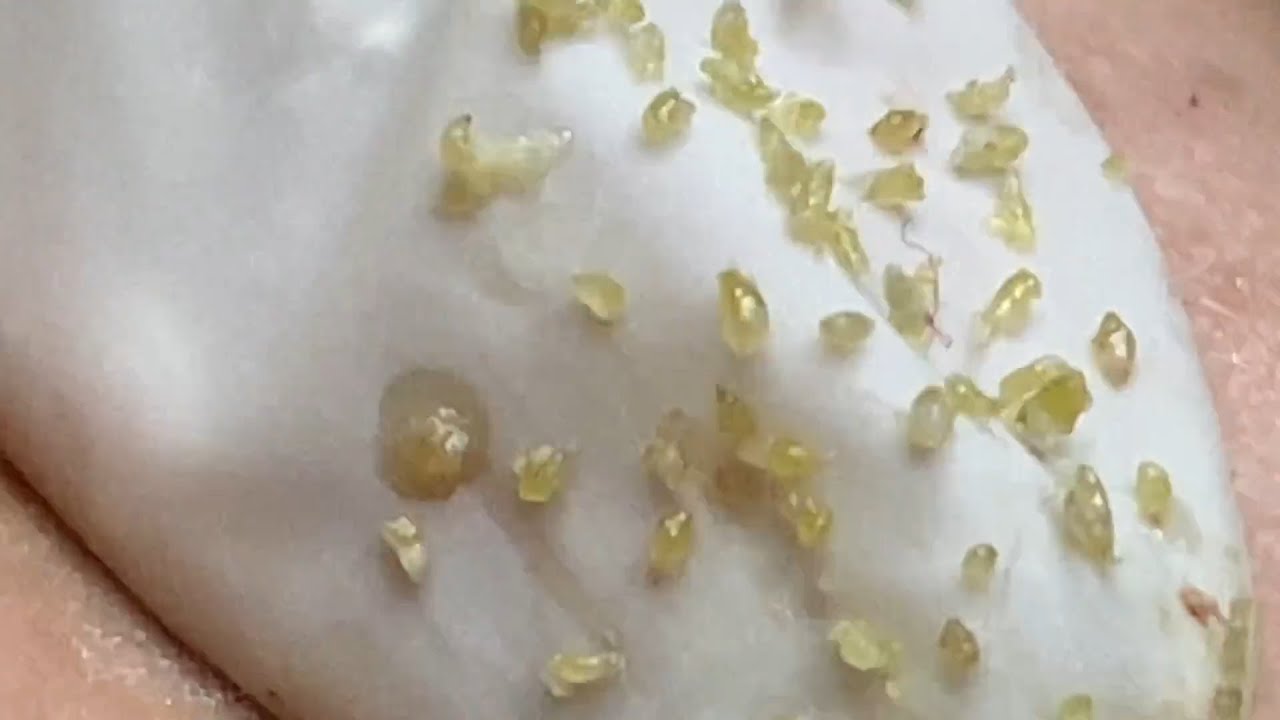 Extracting Blackheads 2019