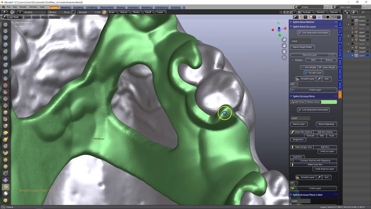 B4D Splint Module - YouTube