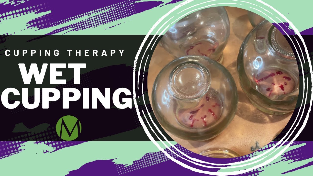 Fire Cupping Therapy + Wet Cupping (Hijama) - YouTube