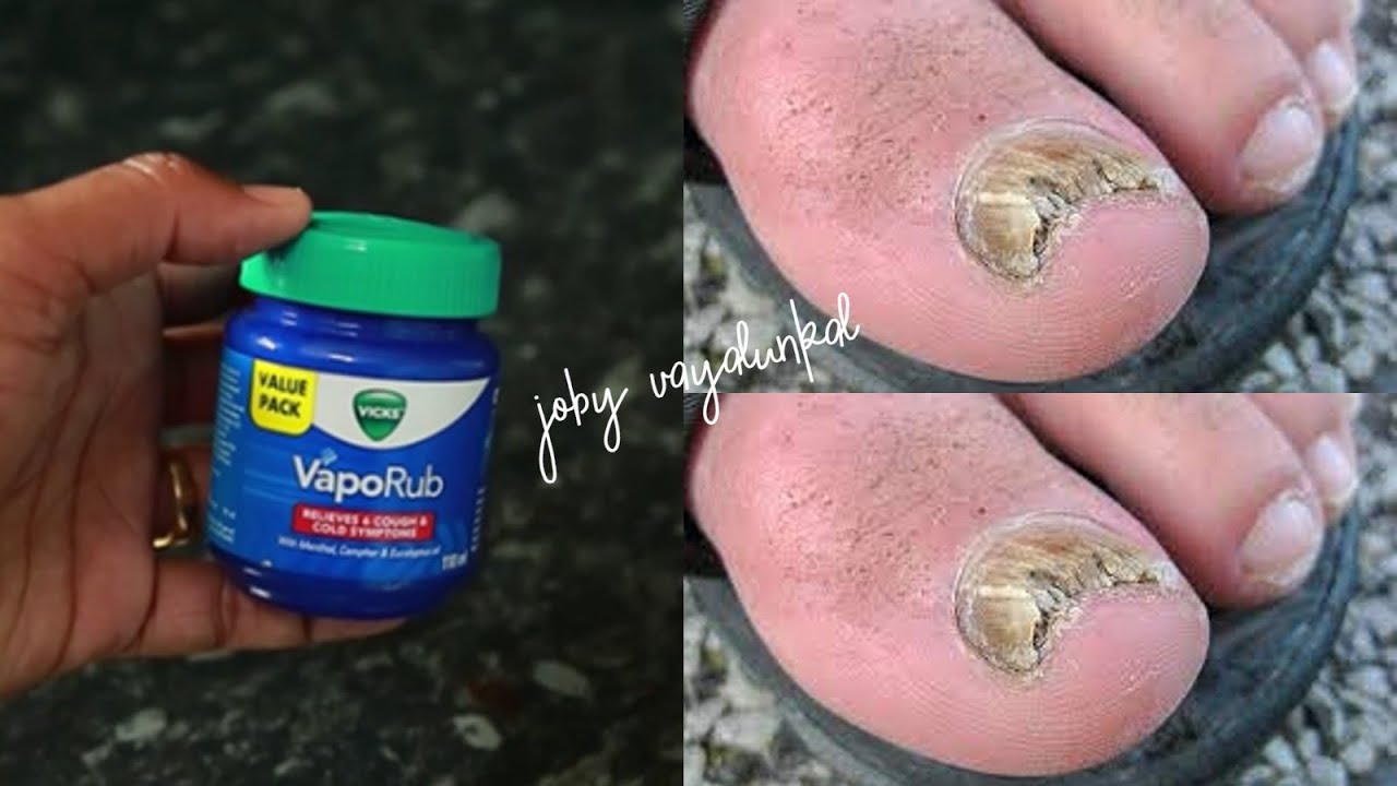 കുഴി നഖം ഇനി ഒരു പ്രശ്നമല്ല 😍 വിക്സ് Vicks Vaporub ഉണ്ടോ How To