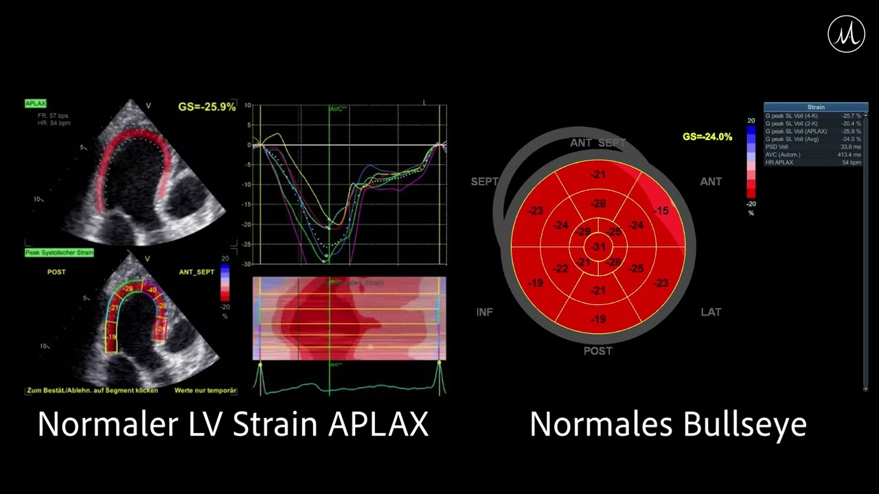 〖Echocardiografie〗Normaler Strain des LV - APLX & Bullseye 🎯🫀 - YouTube