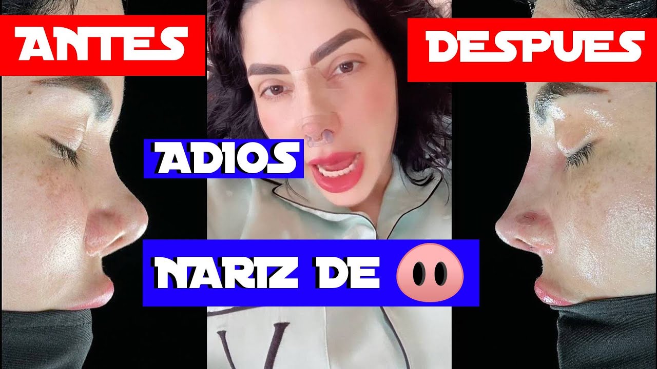 SOL LEÓN RECONSTRUYE SU NARIZ ES UN MILAGRO ADIÓS NARIZ DE 🐽 - YouTube