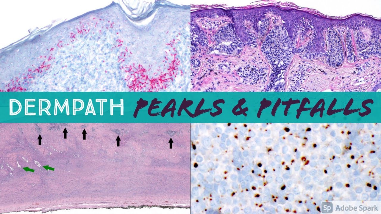 Dermpath Pearls & Pitfalls for General Surgical Pathologists - YouTube