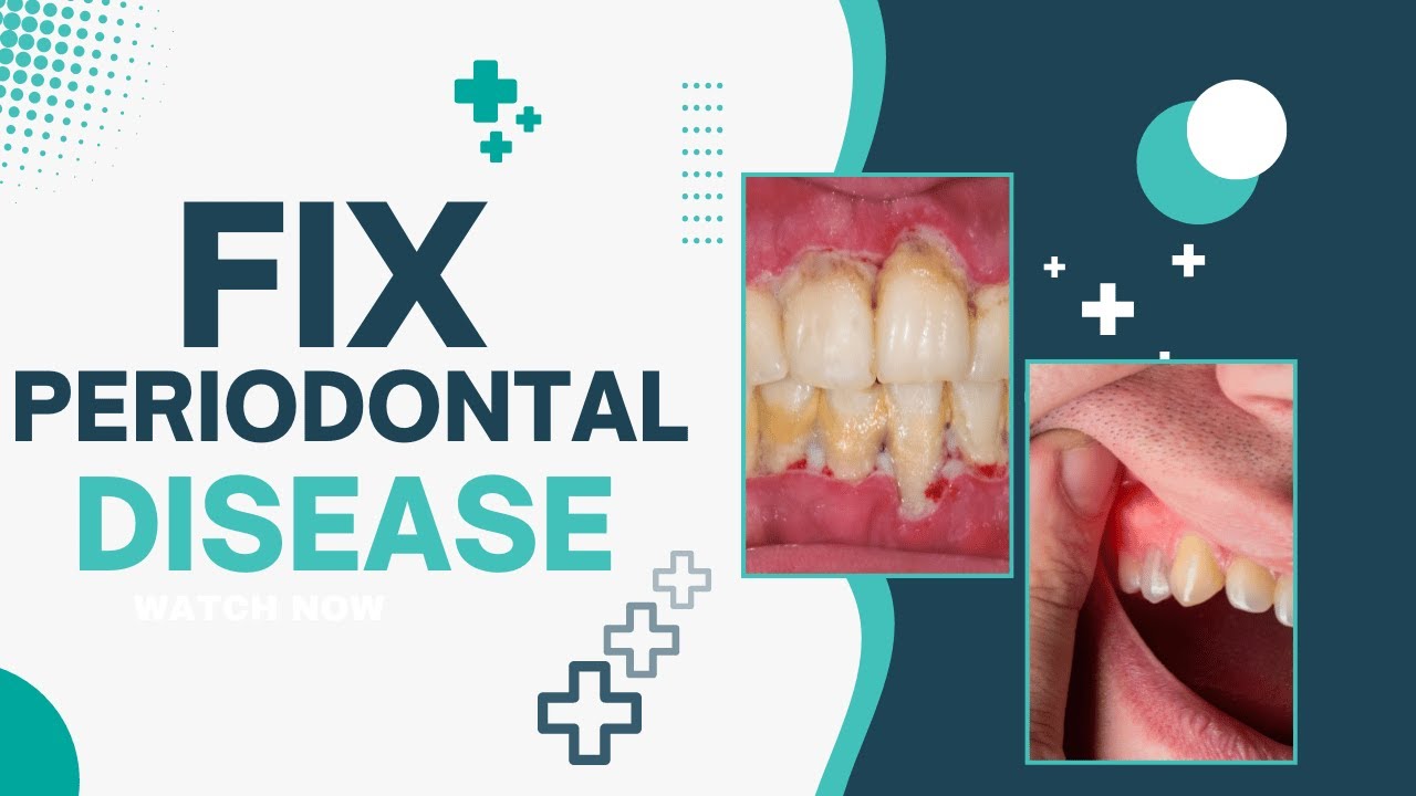How to Reverse and Fix Periodontal Disease: 6 Effective Ways - YouTube