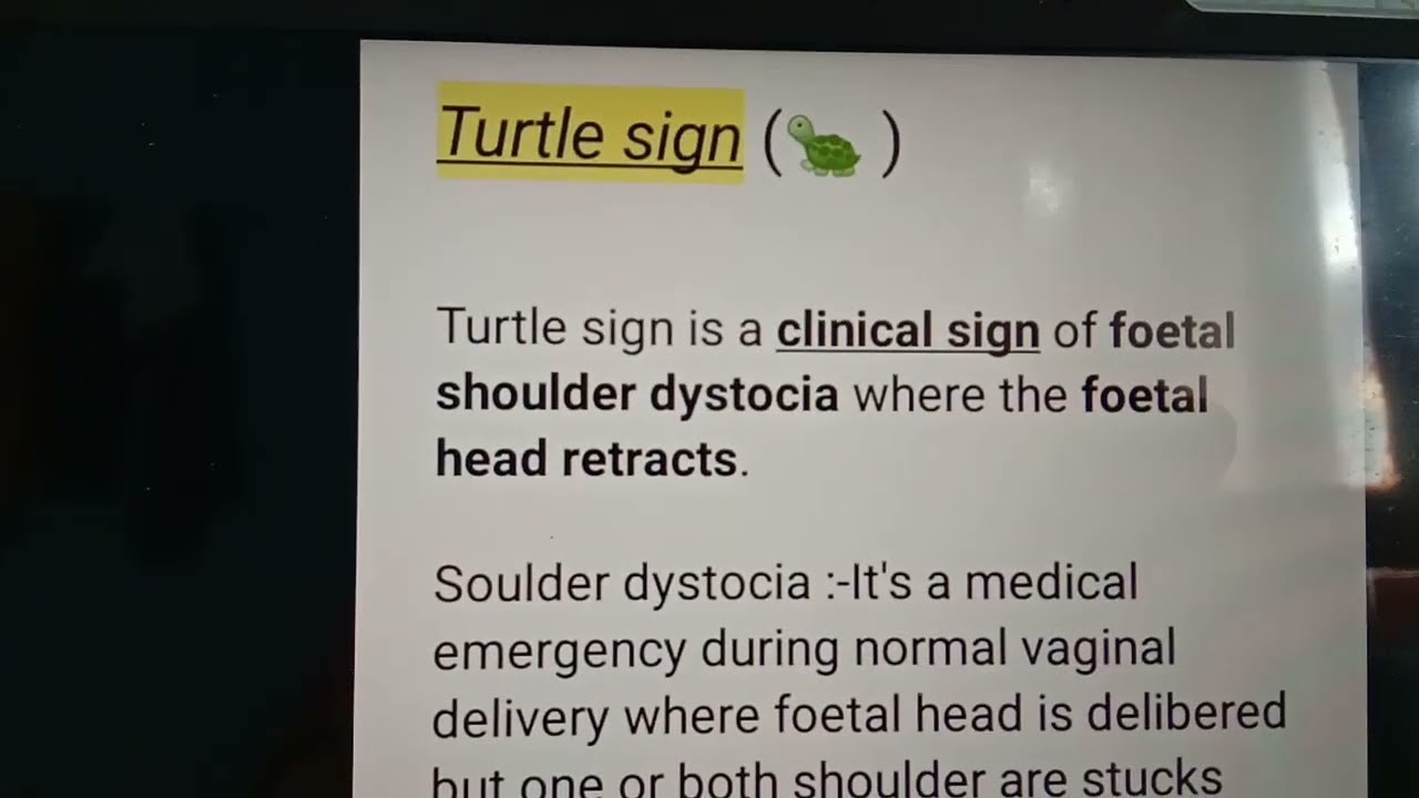 Turtle's sign #shoulder dystocia #nursing #obg - YouTube