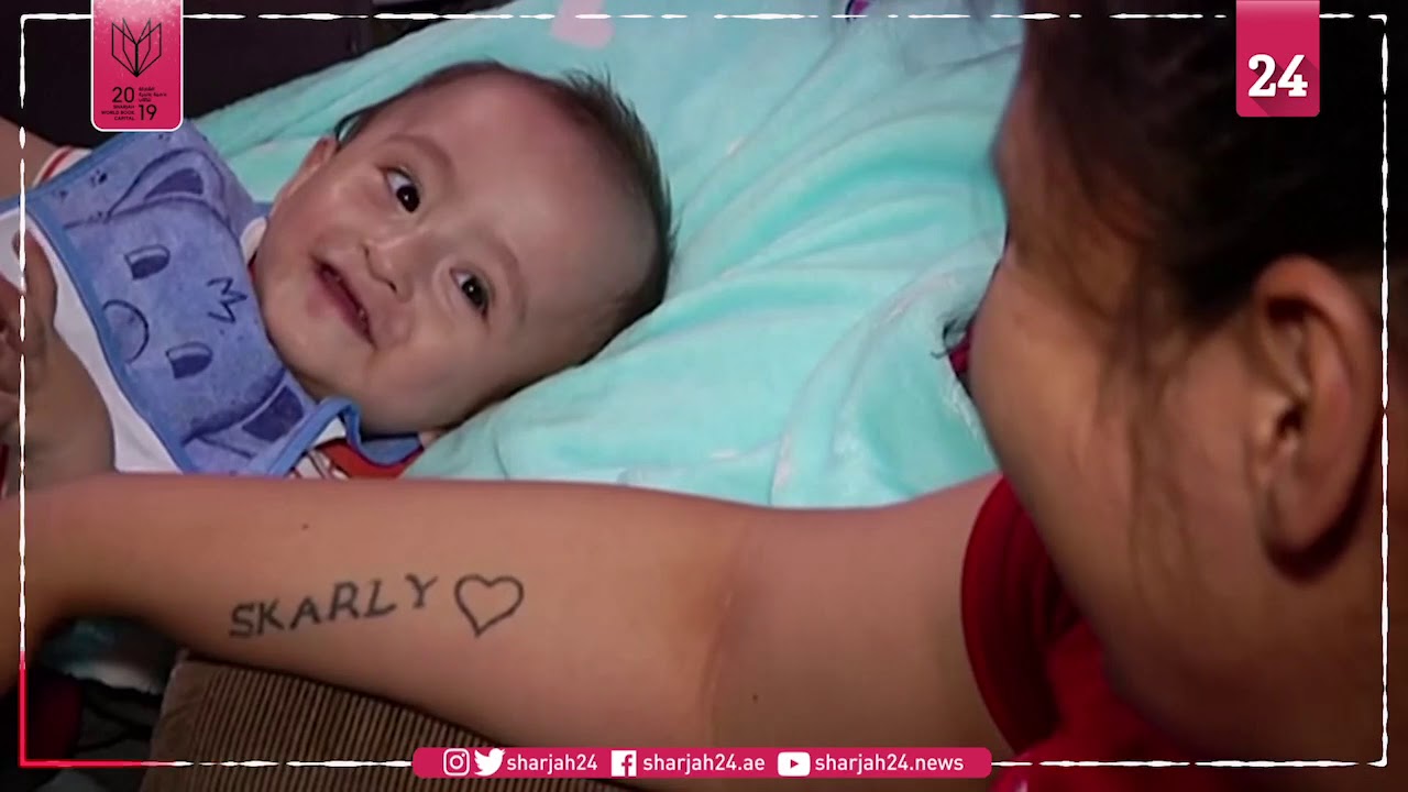 Meet Peru's latest conjoined twins to be surgically separated - YouTube