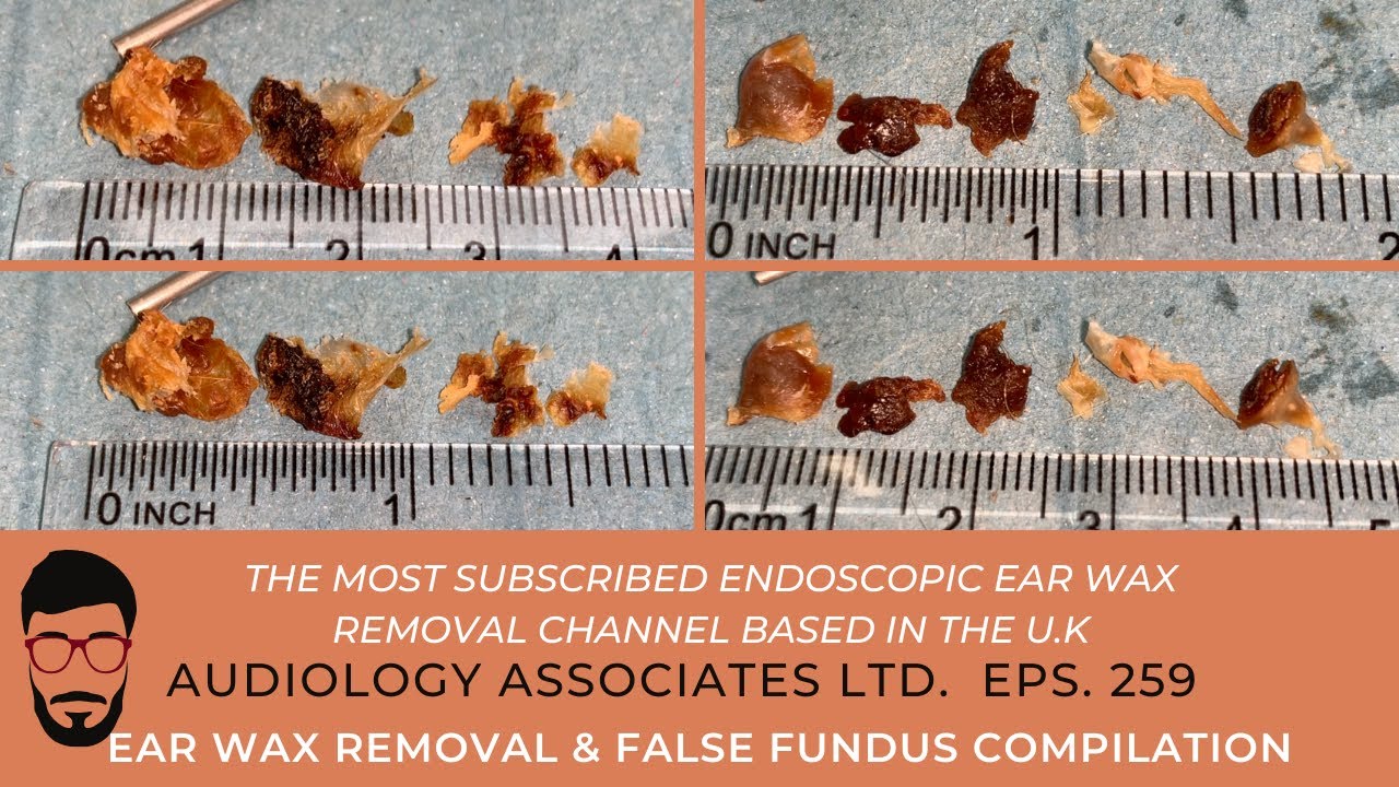 EAR WAX REMOVAL & FALSE FUNDUS COMPILATION - EP259 - YouTube
