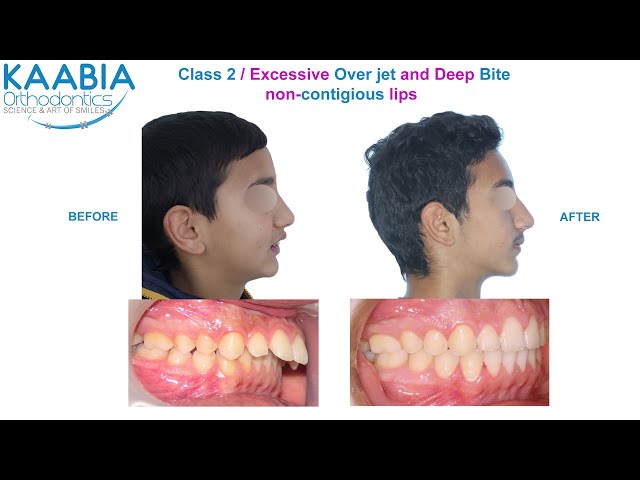 Overjet Bite Before And After