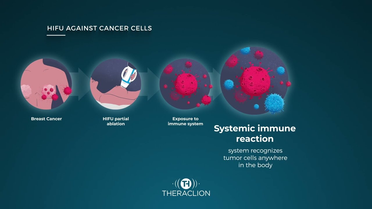 Research on Breast Cancer by the University of Virginia with ECHOPULSE ...